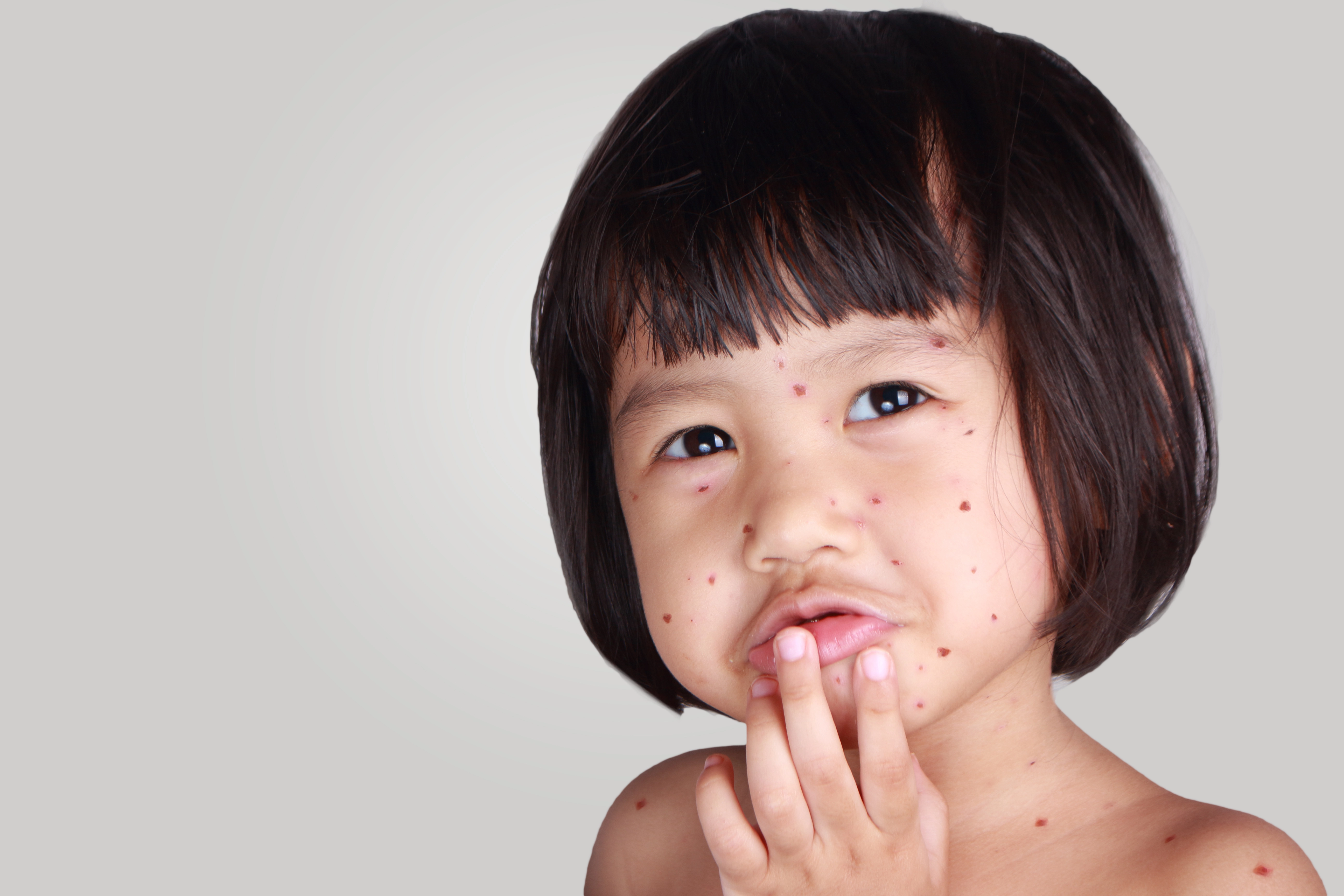 Chickenpox in Children - Healthway Medical