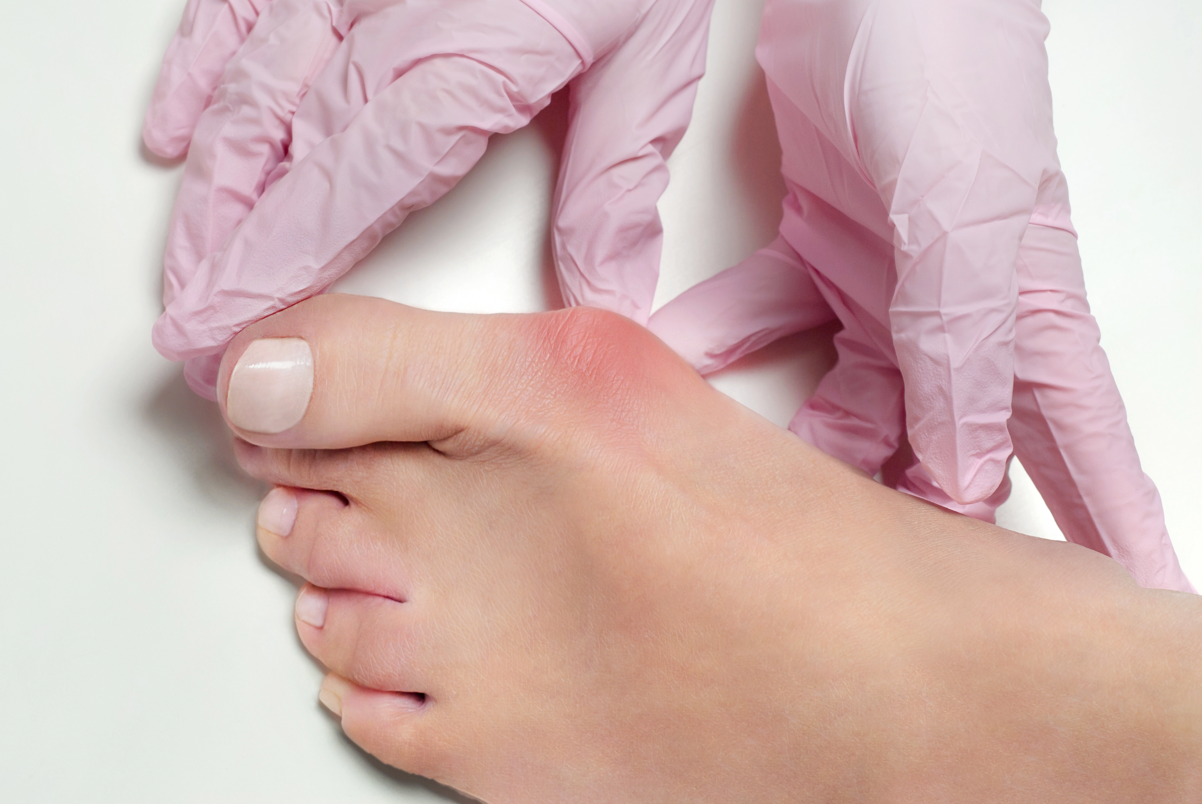 Keyhole Bunion Surgery - Is it for you? - Healthway Medical